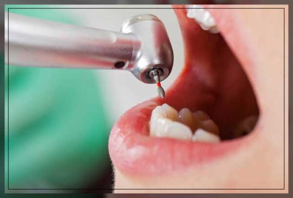 Dental Handpiece: Use, Types and Parts - Engiomed