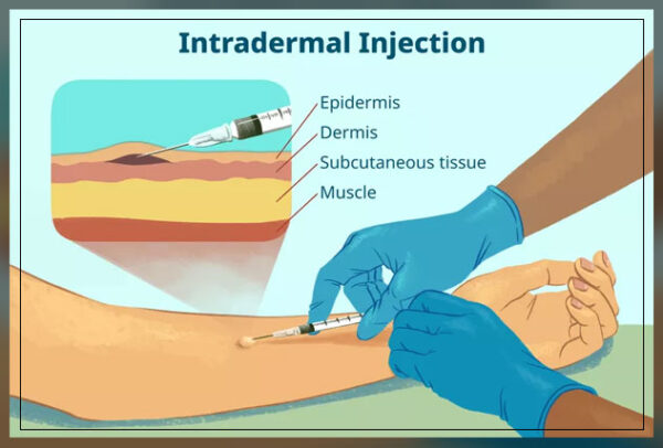Types of Injections and Sites - Engiomed