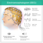 EEG Test(Electroencephalogram): Purpose, Procedure, and Risks - Engiomed