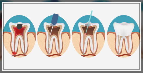 Dental Gutta-Percha: Use and Benefits - Engiomed
