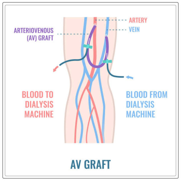 Kidney Dialysis, Types, Working, Procedure, and More - Engiomed