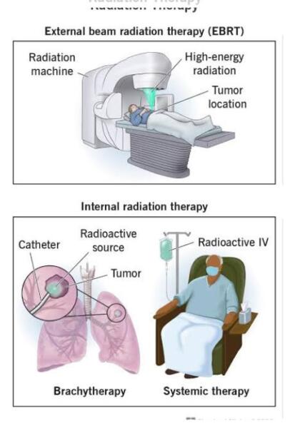 Radiation Therapy: Types, Purpose, Side Effects, and More - Engiomed